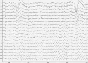 Quantitative EEG & BrainMap – Neurofeedback Luxembourg